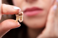 What Are The Stages Of Tooth Decay What Are The Stages Of Tooth Decay